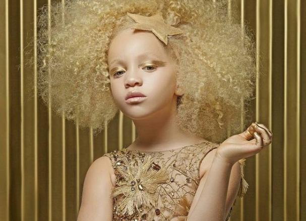 How an African albino girl has turned her peculiarity into a virtue